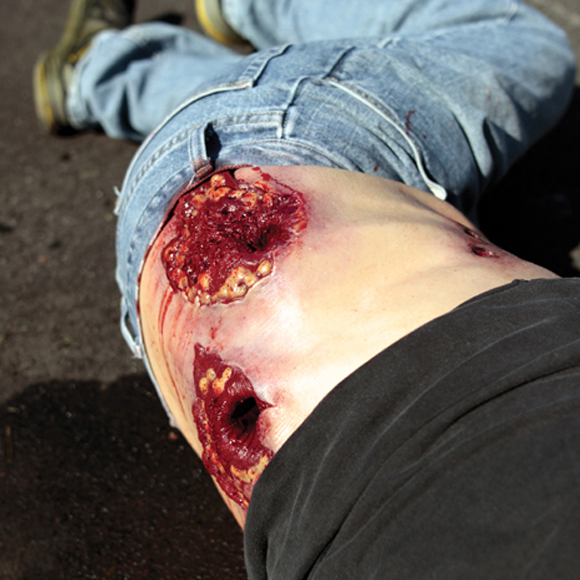 Gunshot Wound Set of the Abdomen, Entry and Exit Wounds WW3-901 ...